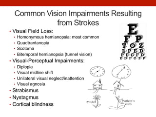 Vision Deficits Post-Stroke In-Service | PDF