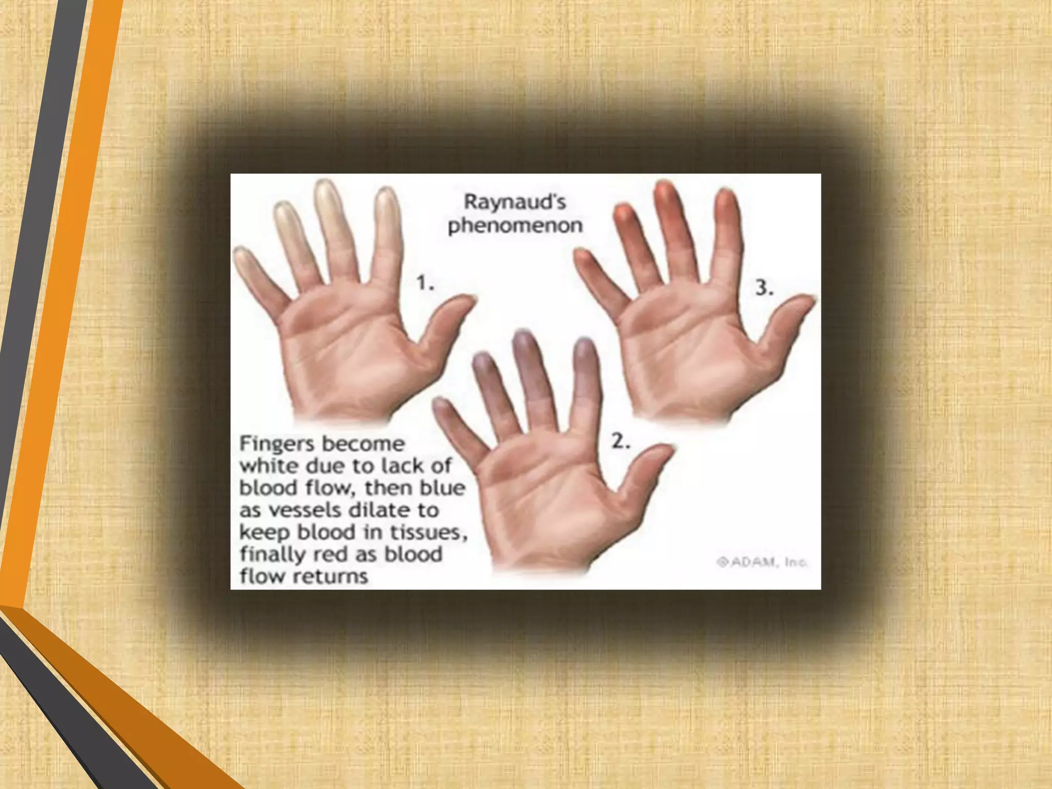 Fenomeno de Raynaud & Esclerodermia | PPT