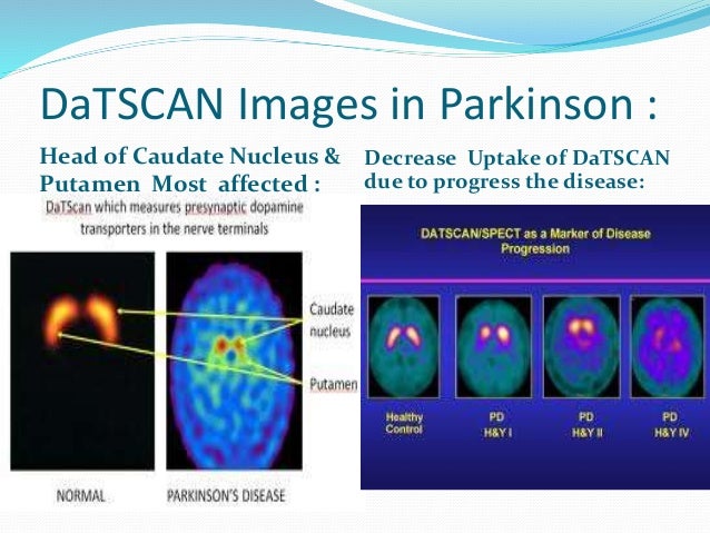 Dementia Power. Point