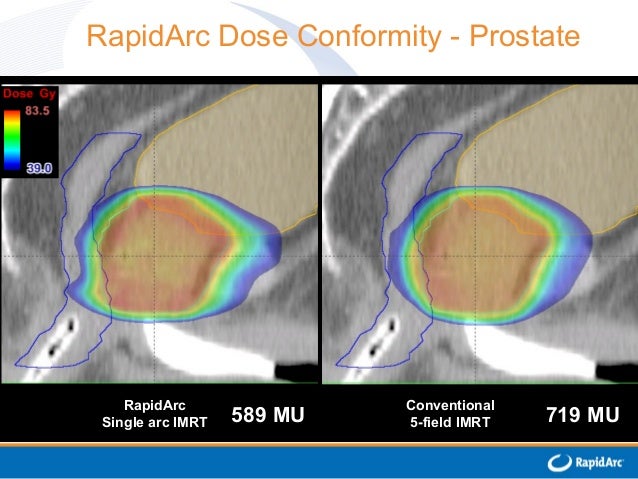 RapidArc PowerPoint Presentation