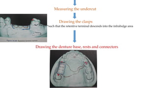 fabrication-of-rpd_compress.pdf dentistry | PDF