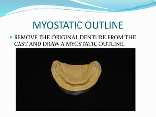 Fabrication of a new full lower denture revised | PPTX