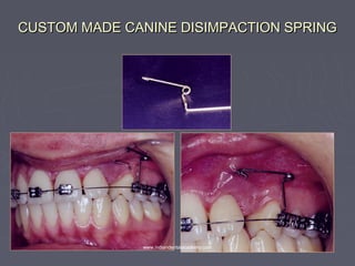 Fabrication of k 9 spring | PPT