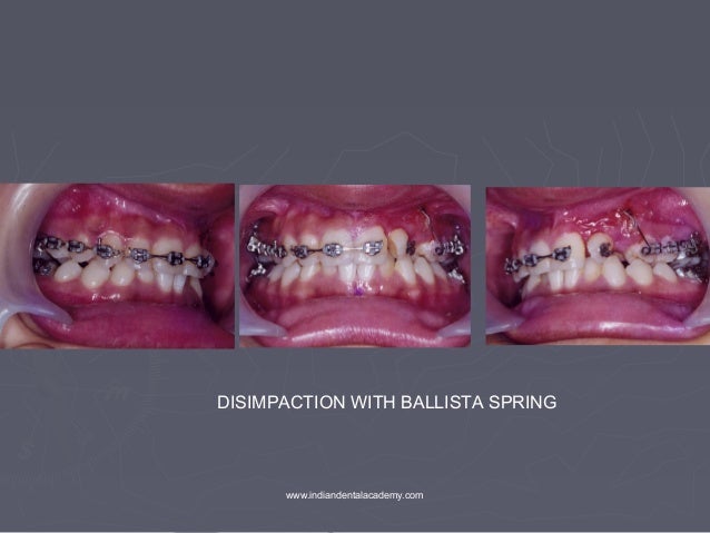 Fabrication of k 9 spring