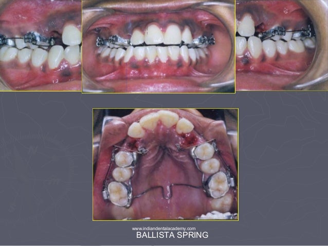 Fabrication of k 9 spring