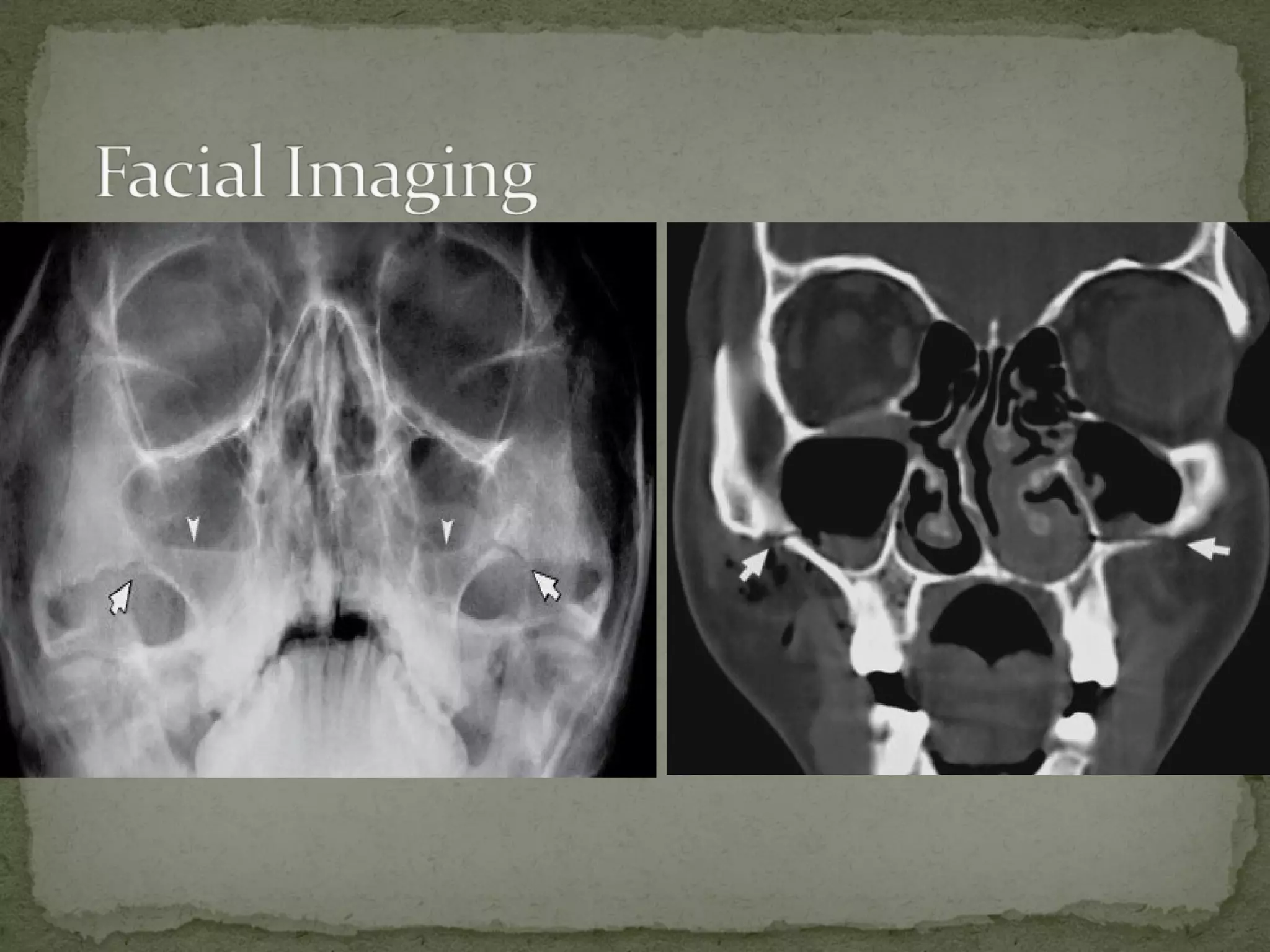 Lefort 1 Fracture | PPT