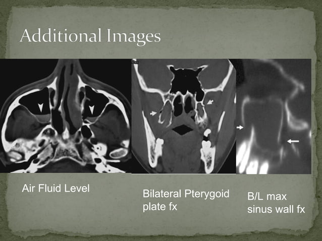 Lefort 1 Fracture | PPT | Death, Injury, or Military Conflict ...