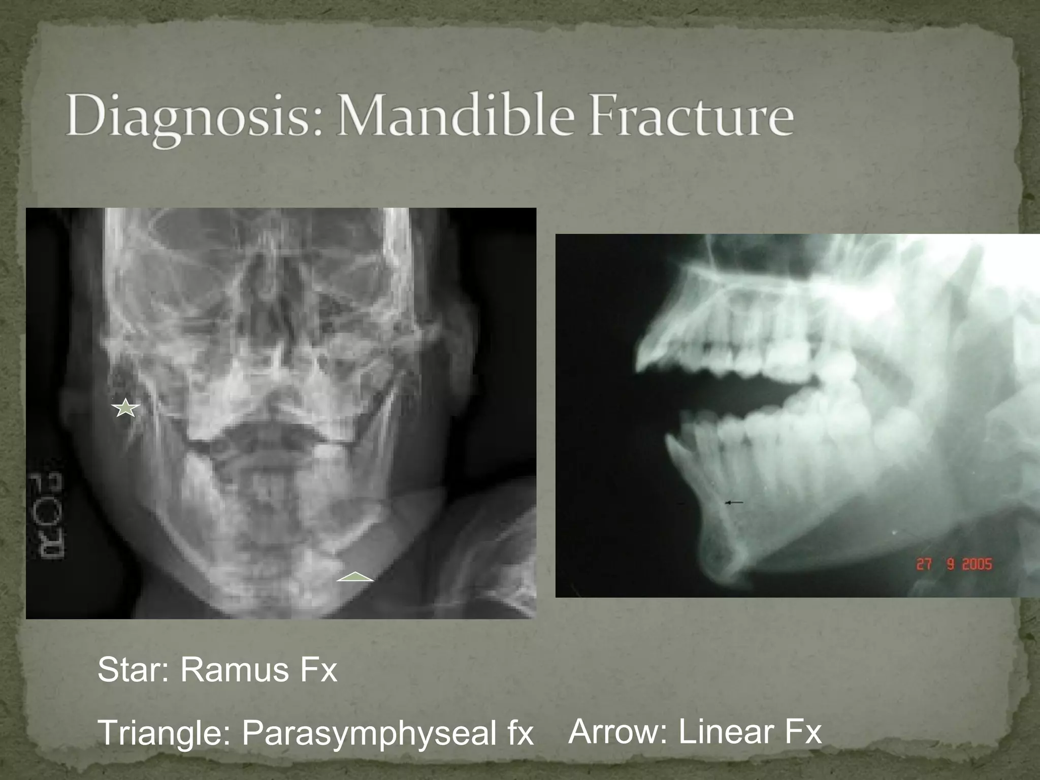 Mandibular Fracture | PPT