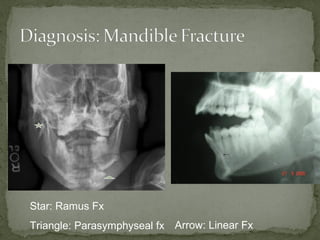 Mandible Fracture Panorex
