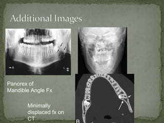 Mandible Fracture Panorex