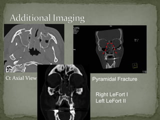 Lefort 2 Fracture | PPT