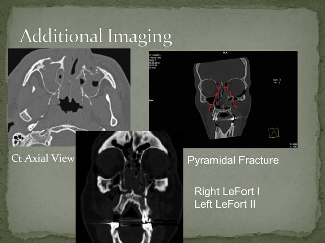 Lefort 2 Fracture | PPT