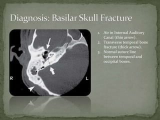 Basilar Skull Fracture | PPTX