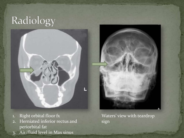 Orbital Blowout Fracture | PPT
