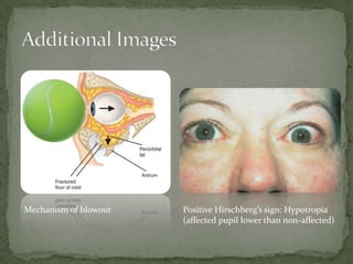 Orbital Blowout Fracture | PPT