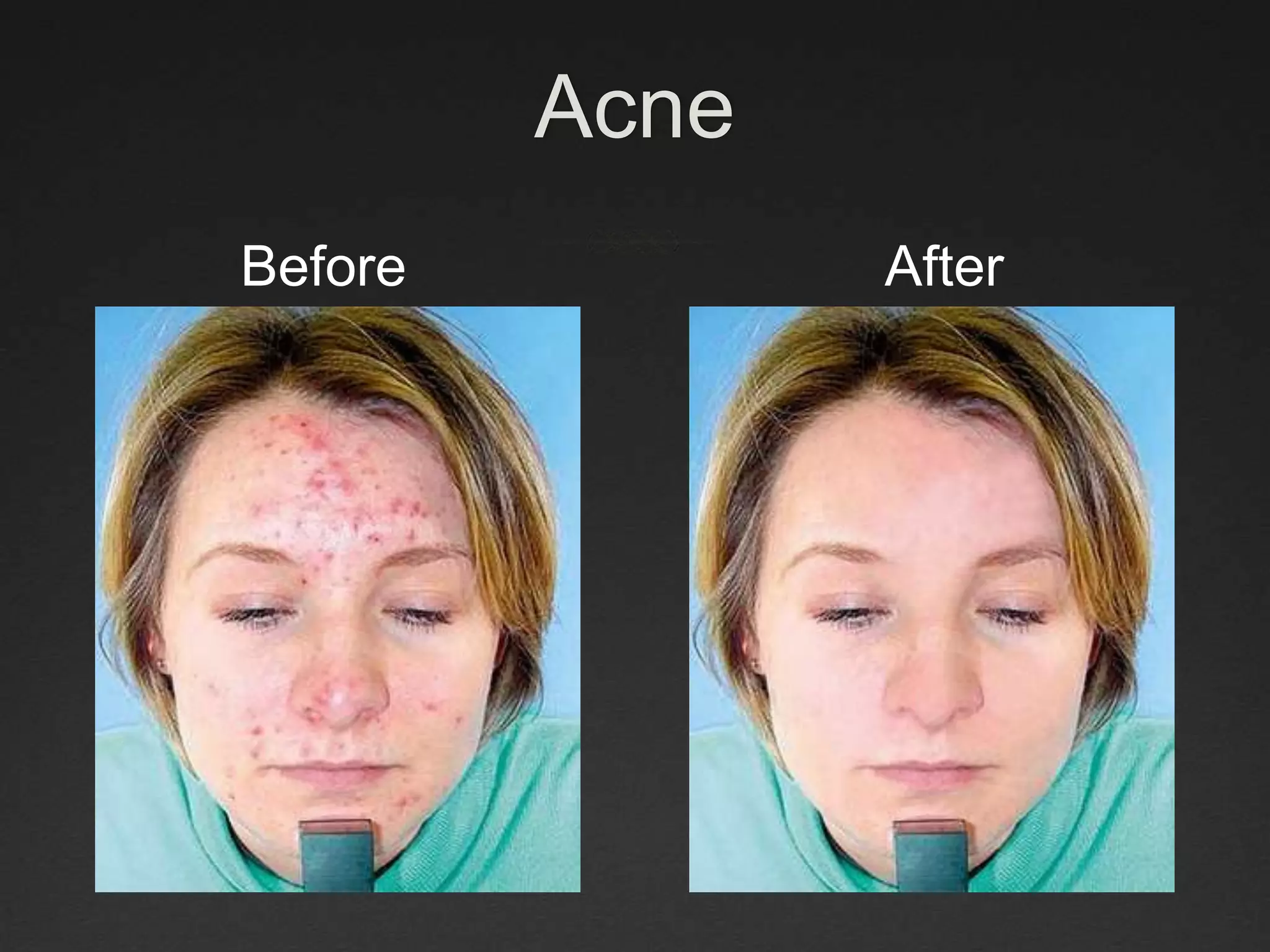 Face blemishes powerpoint | PPTX