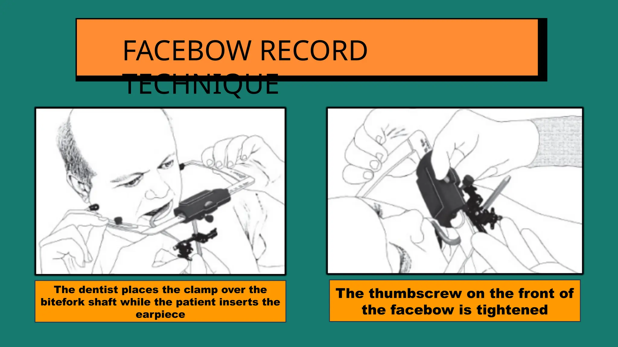 Facebow record, transfer and articulation | PPTX