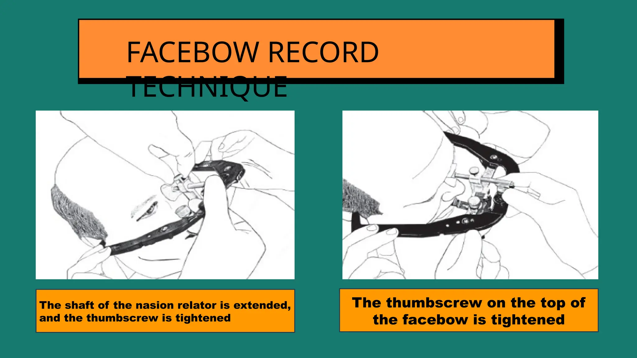 Facebow record, transfer and articulation | PPTX