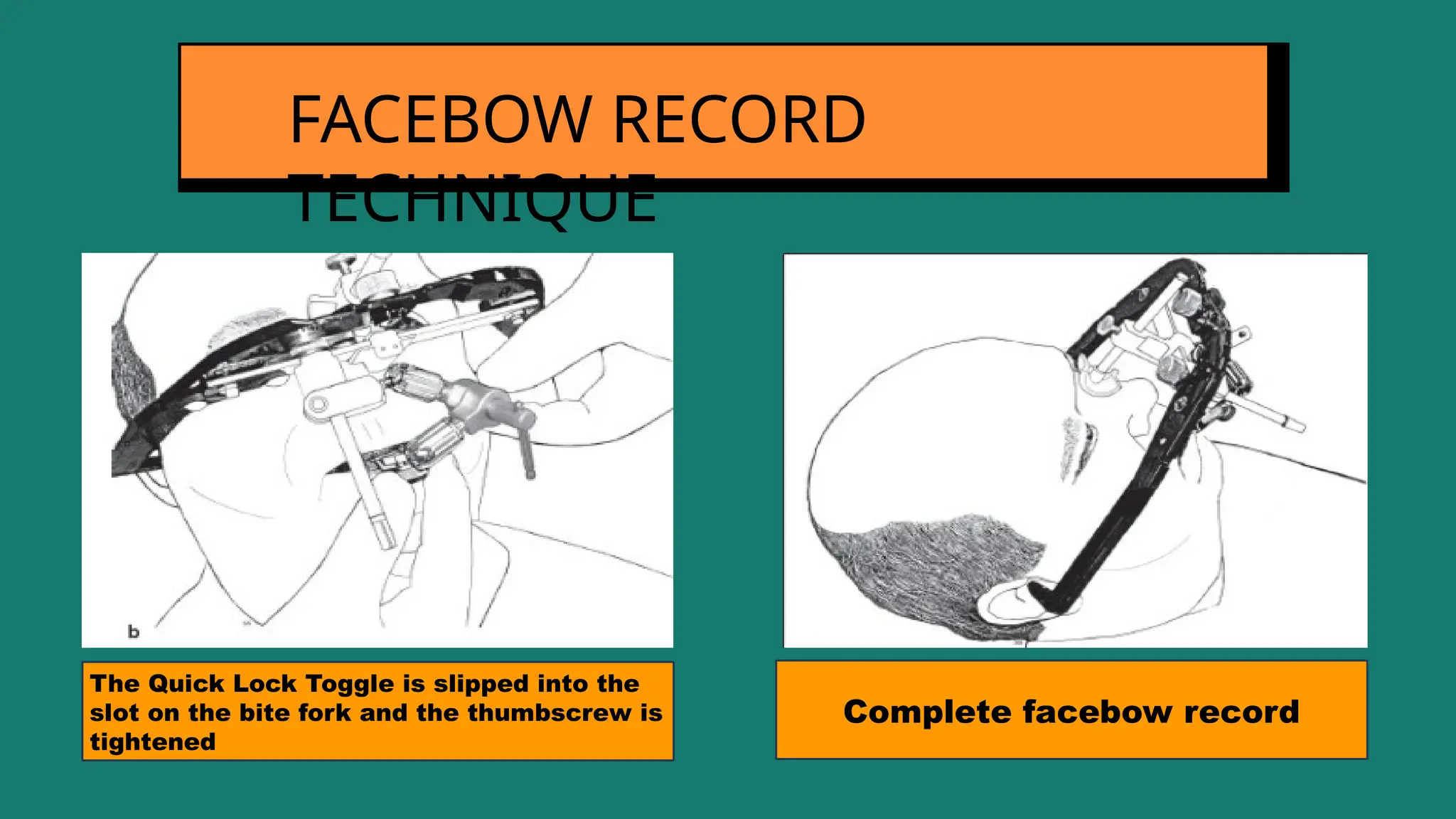Facebow record, transfer and articulation | PPTX