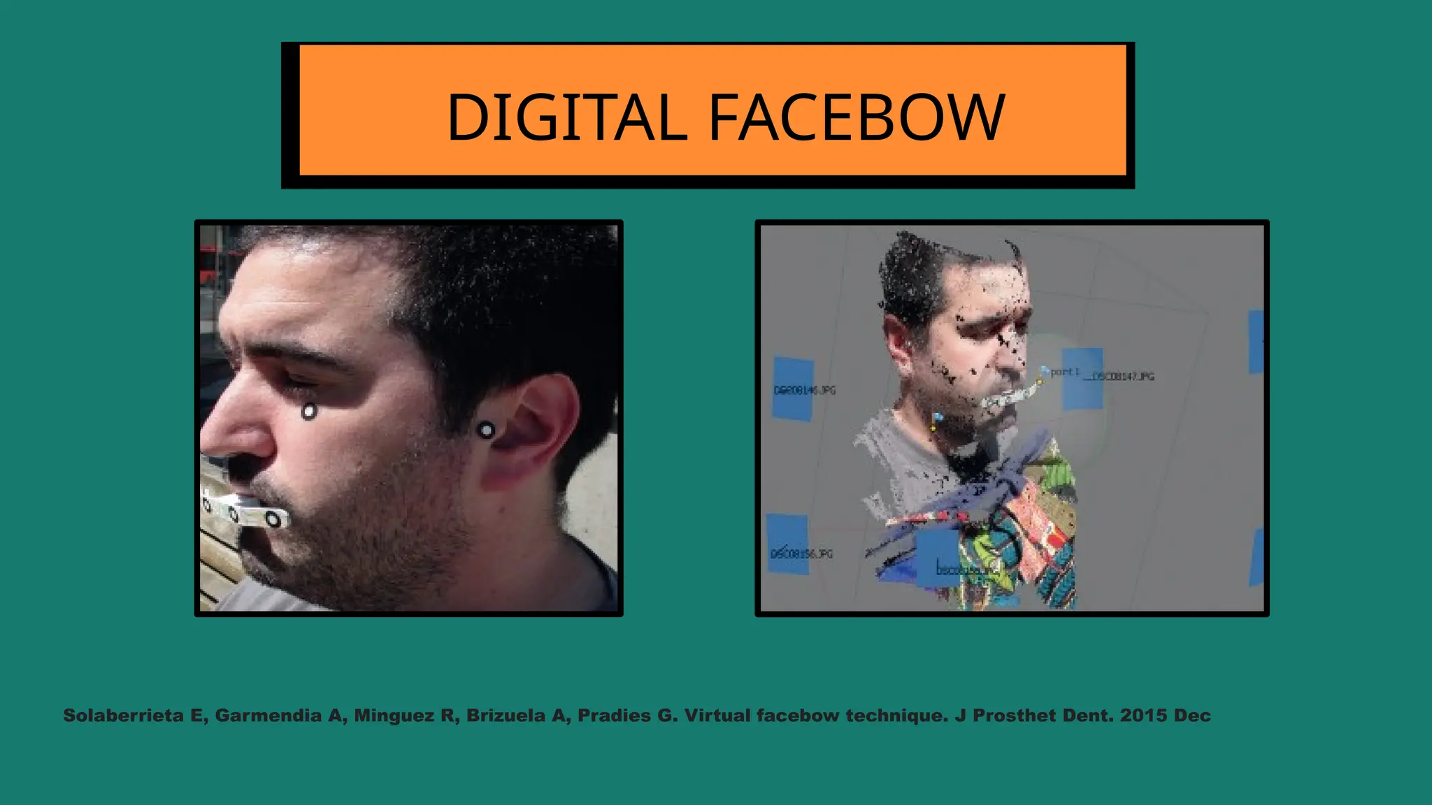 Facebow record, transfer and articulation | PPTX