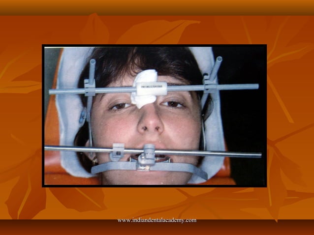 Facebow in orthodontics /certified fixed orthodontic courses by Indian ...