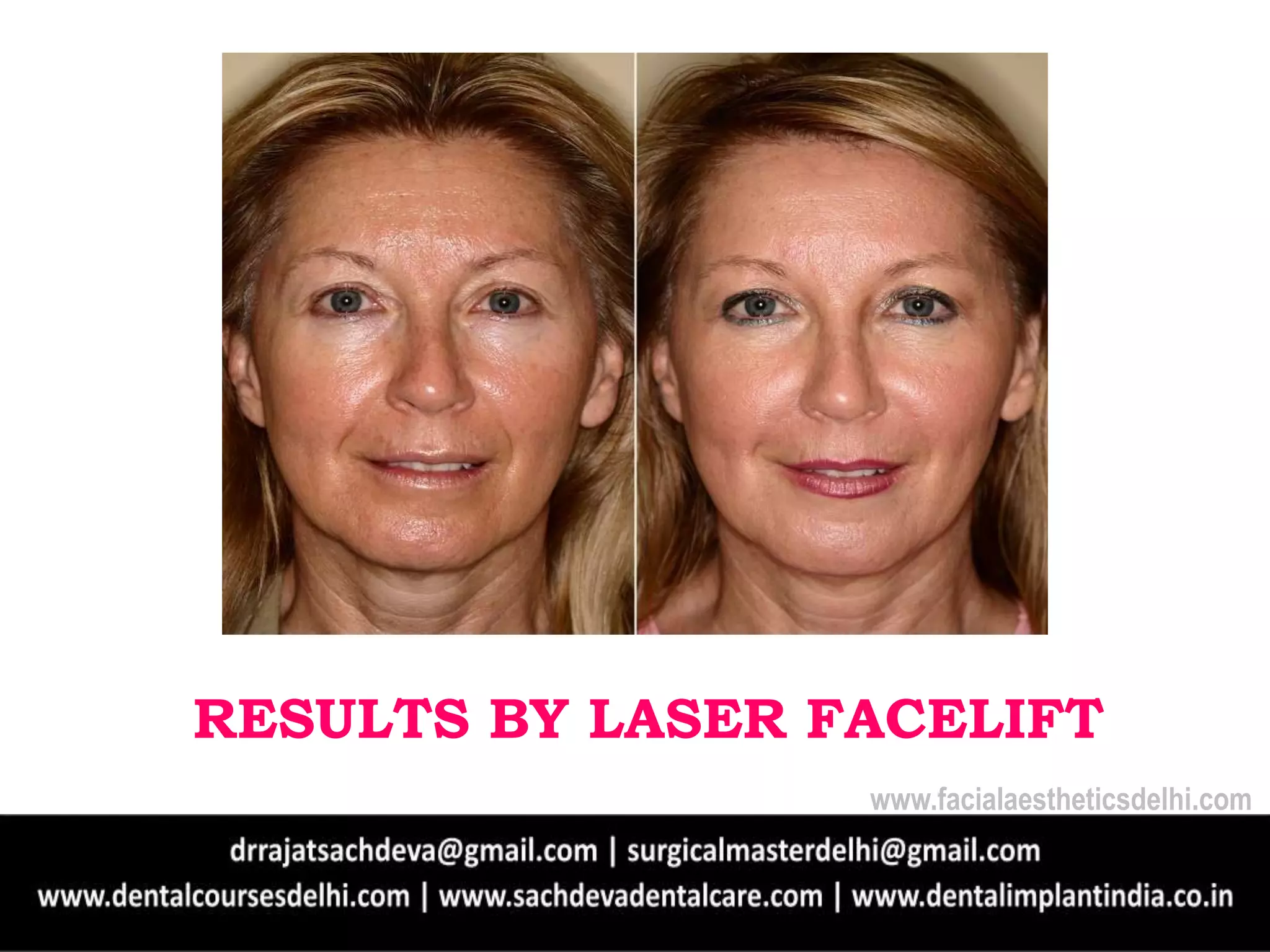 Face lift without surgery | PPTX