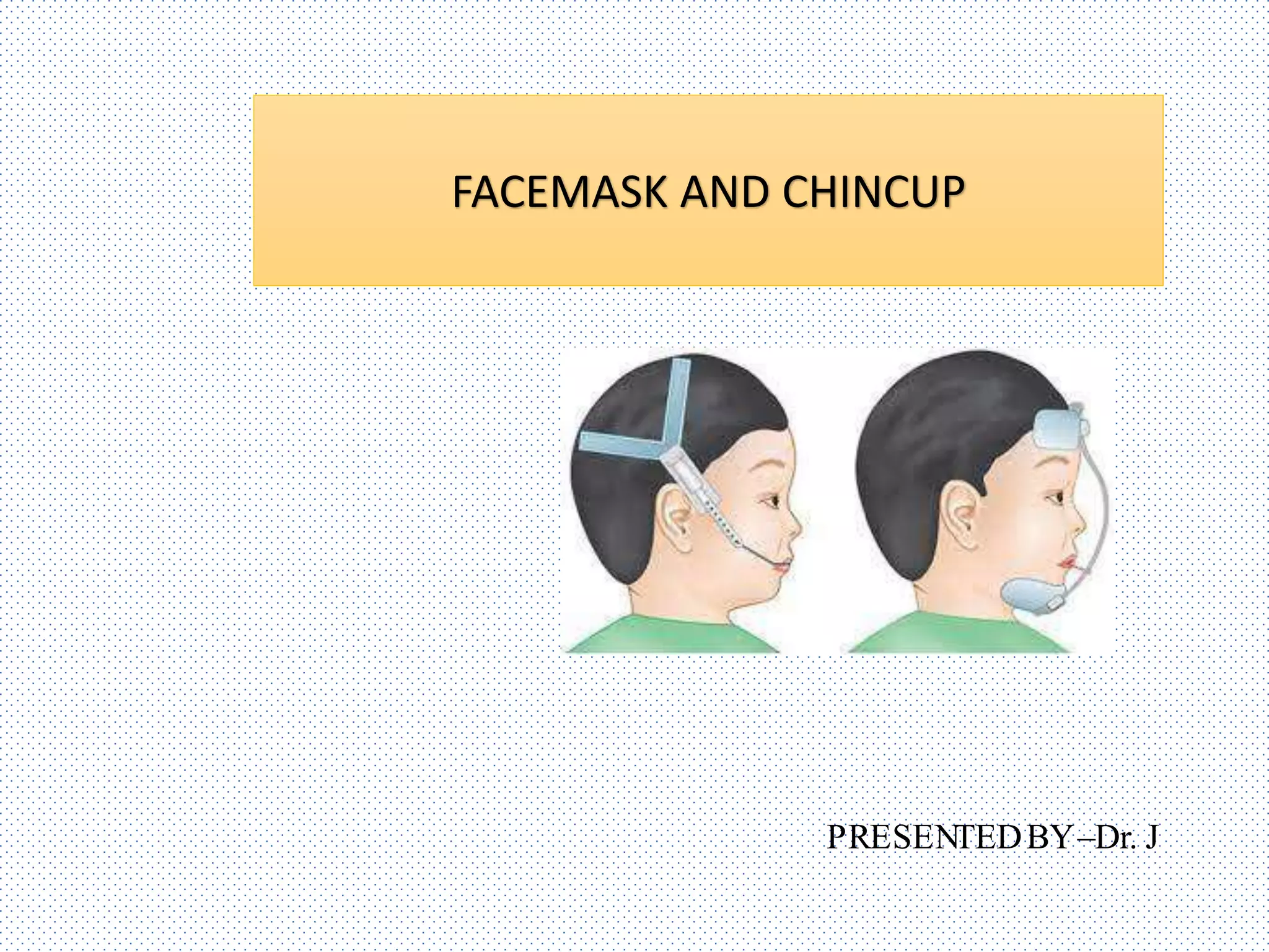 FACEMASK CHINCUP SEMINAR[1].pptx