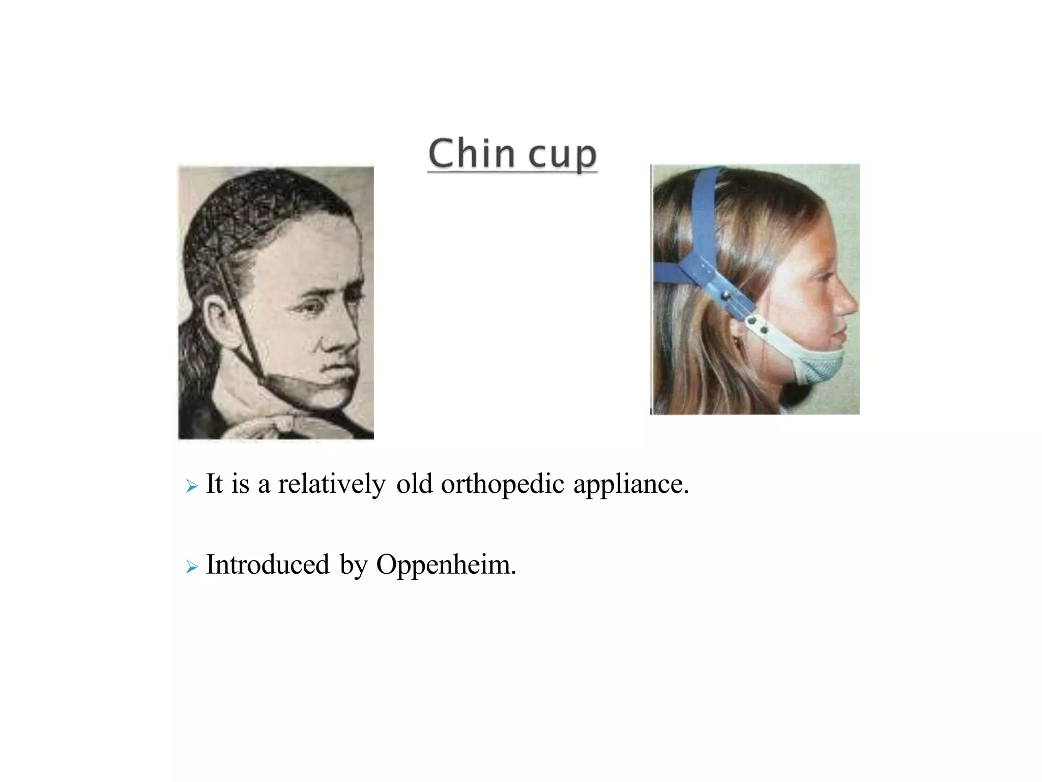 FACEMASK CHINCUP SEMINAR[1].pptx