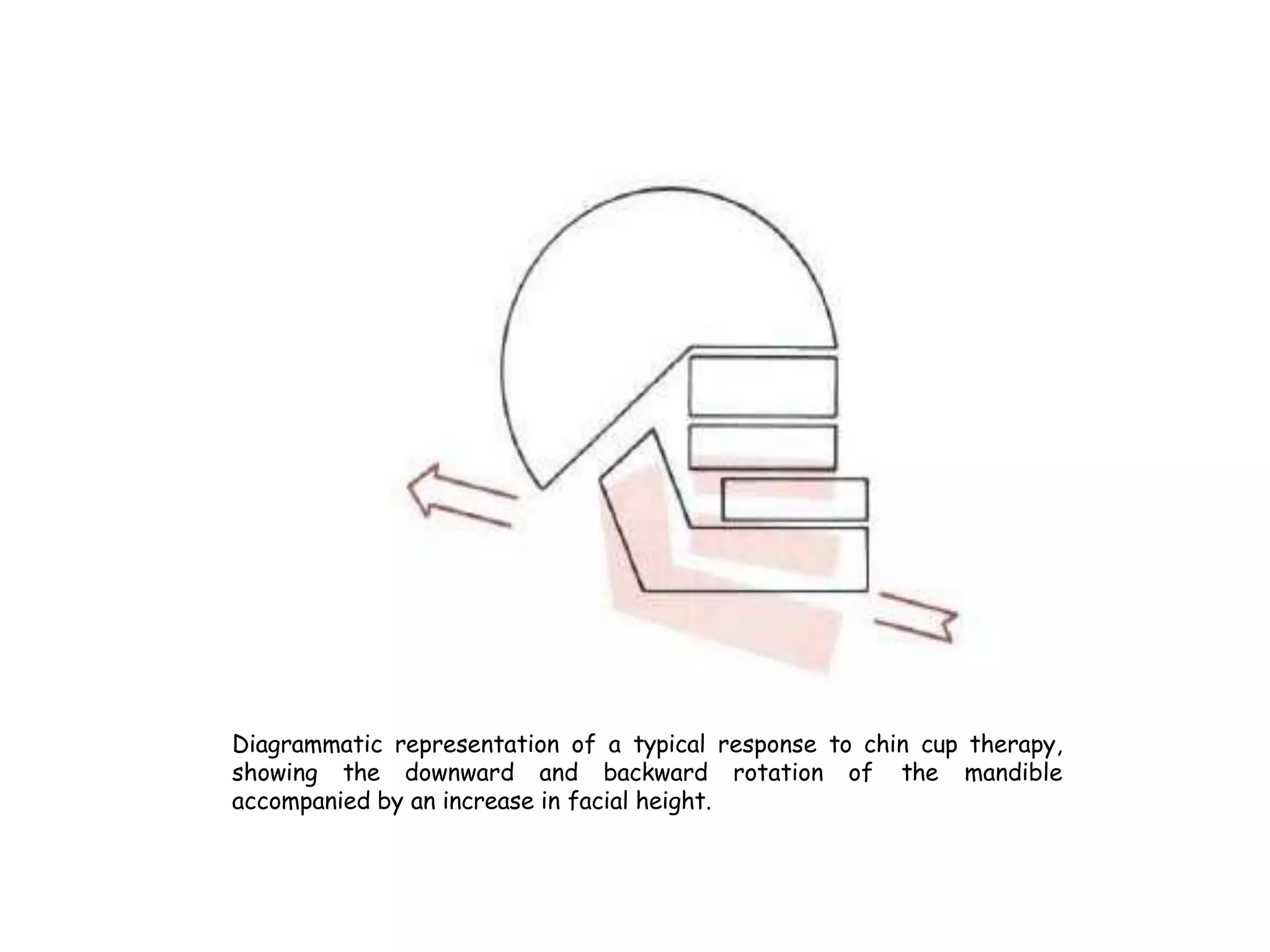 FACEMASK CHINCUP SEMINAR[1].pptx