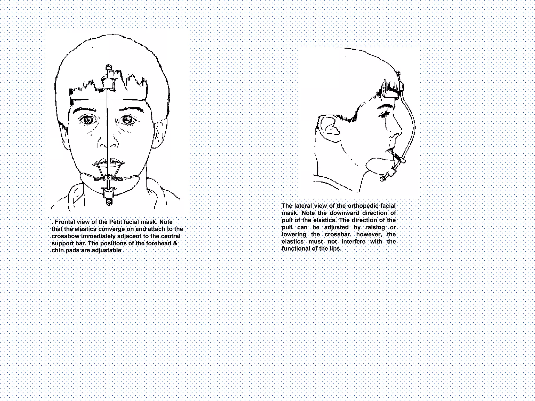 FACEMASK CHINCUP SEMINAR[1].pptx