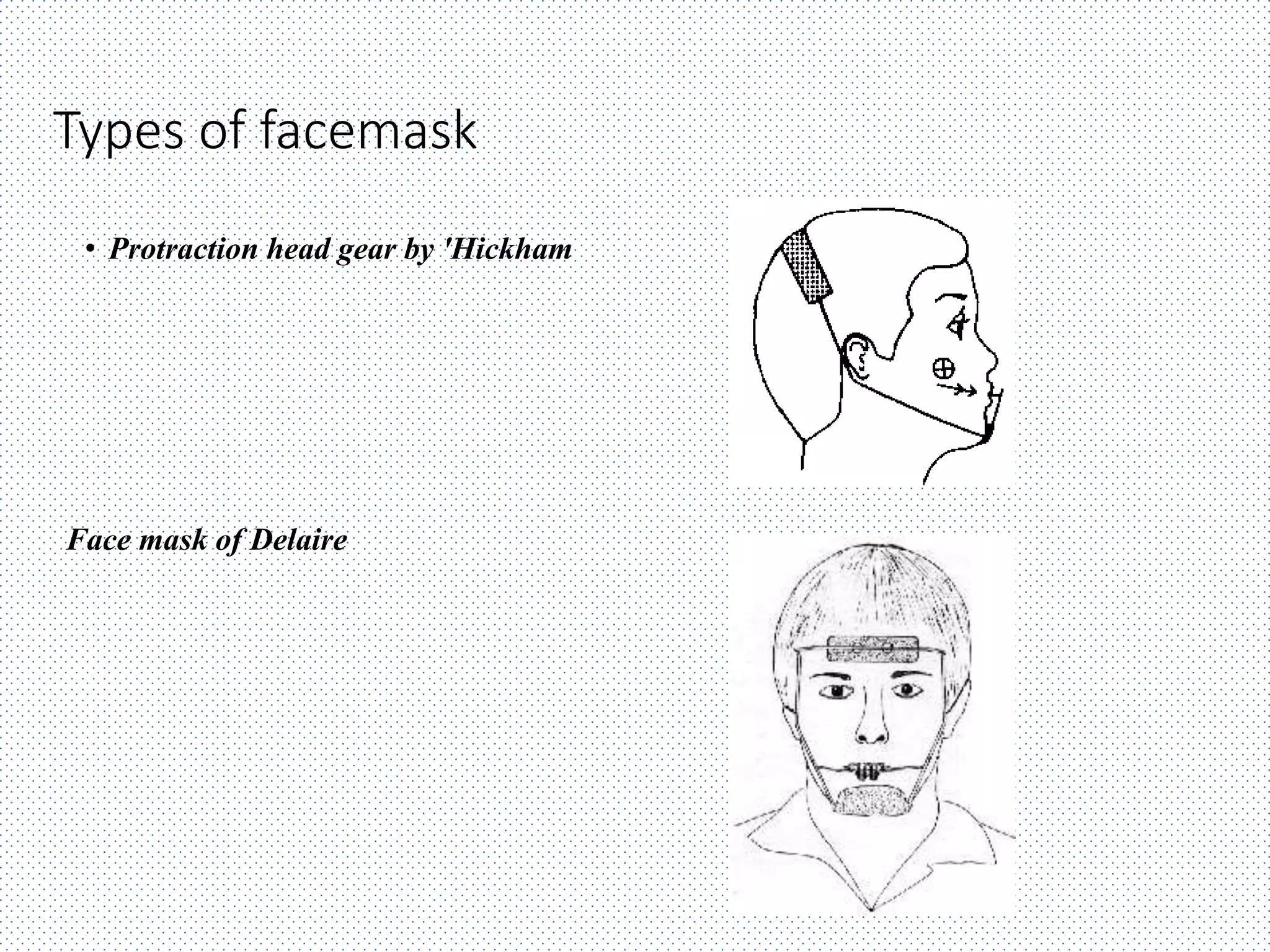 FACEMASK CHINCUP SEMINAR[1].pptx