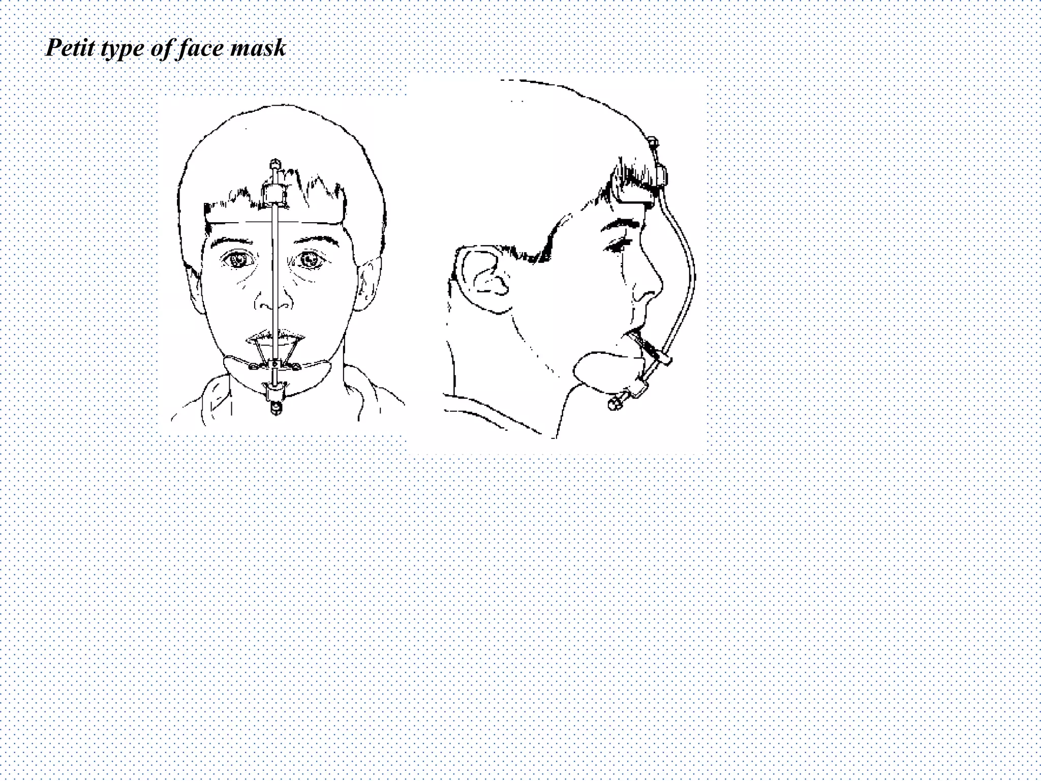 FACEMASK CHINCUP SEMINAR[1].pptx