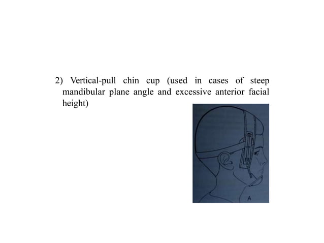 FACEMASK CHINCUP SEMINAR[1].pptx