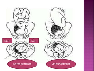 Face Presentation Mentum Posterior