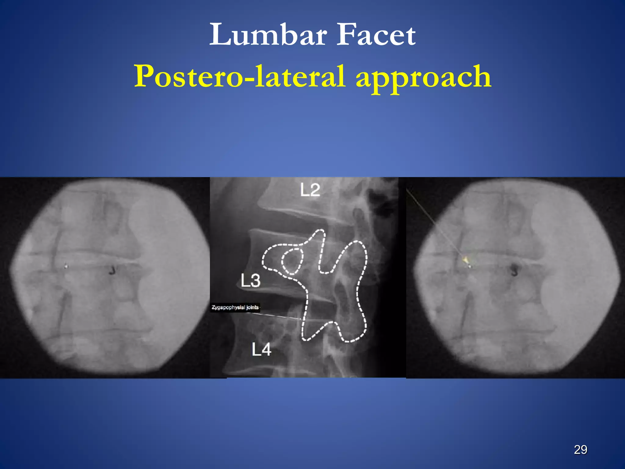 Facet joint injection | PPTX