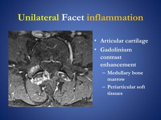 Facet joint injection | PPTX