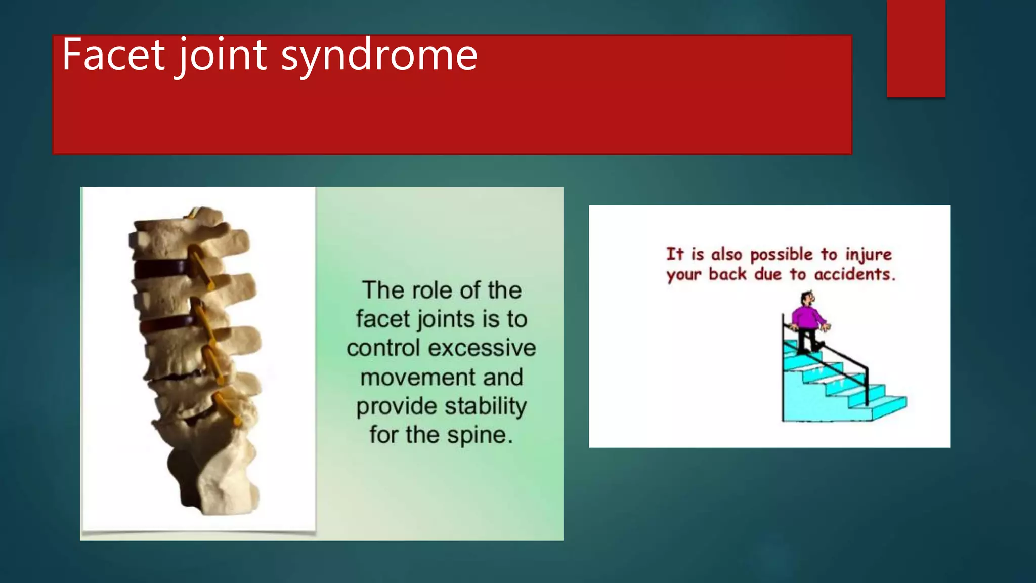 Facet joint syndrome | PPTX