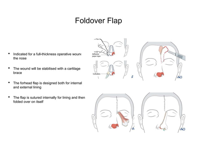 FACIAL.FLAPS.2022.pptx