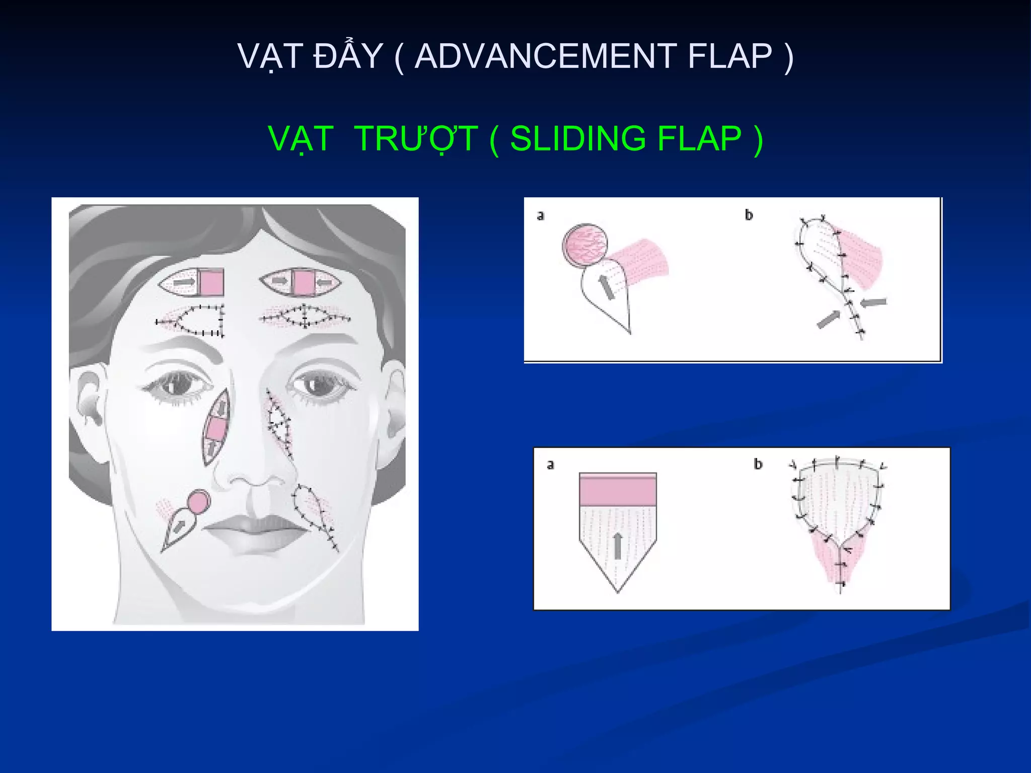 Facial Flap | PPT