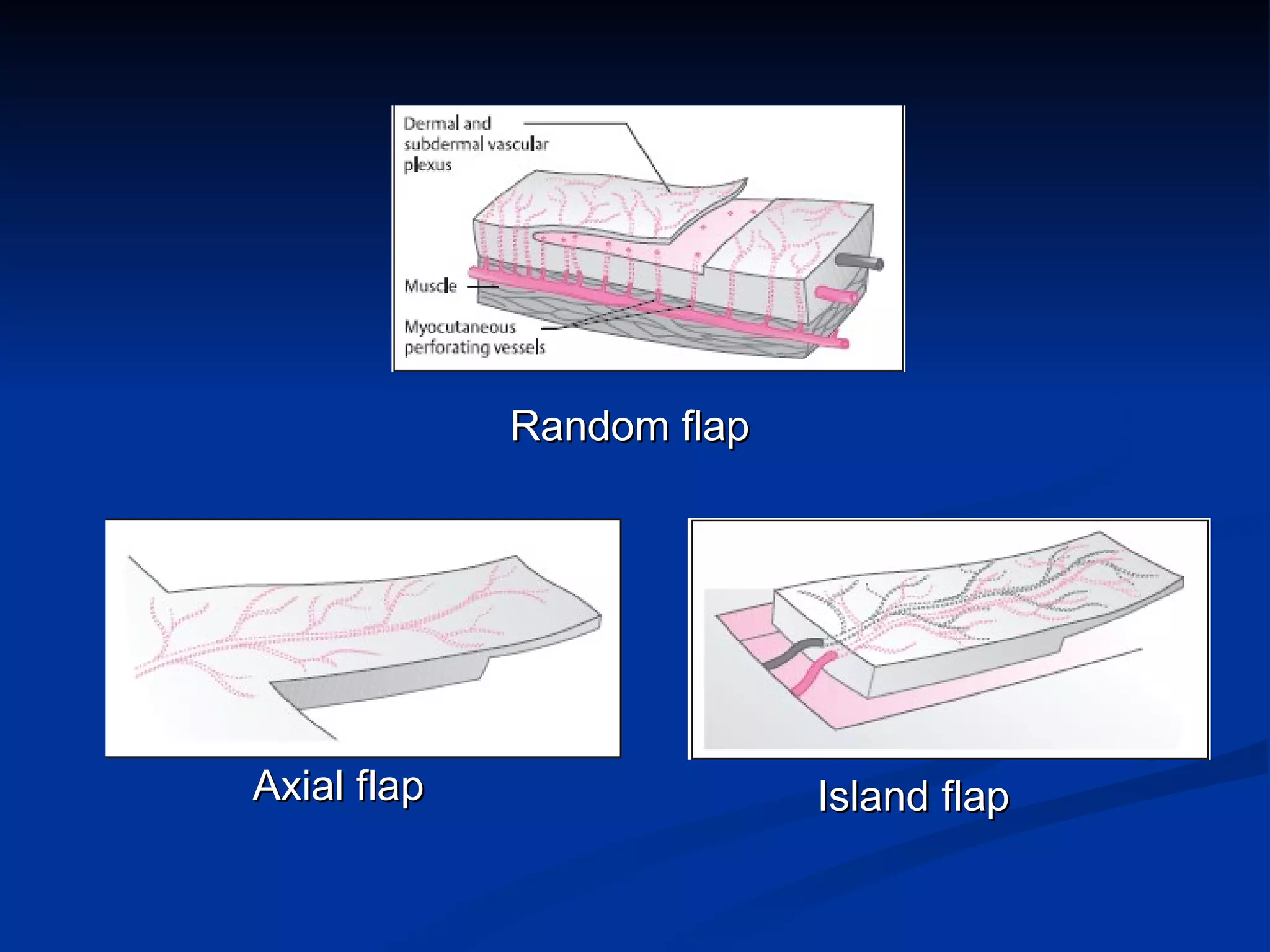 Facial Flap | PPT