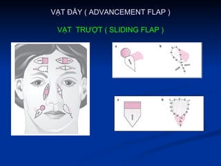 Facial Flap | PPT