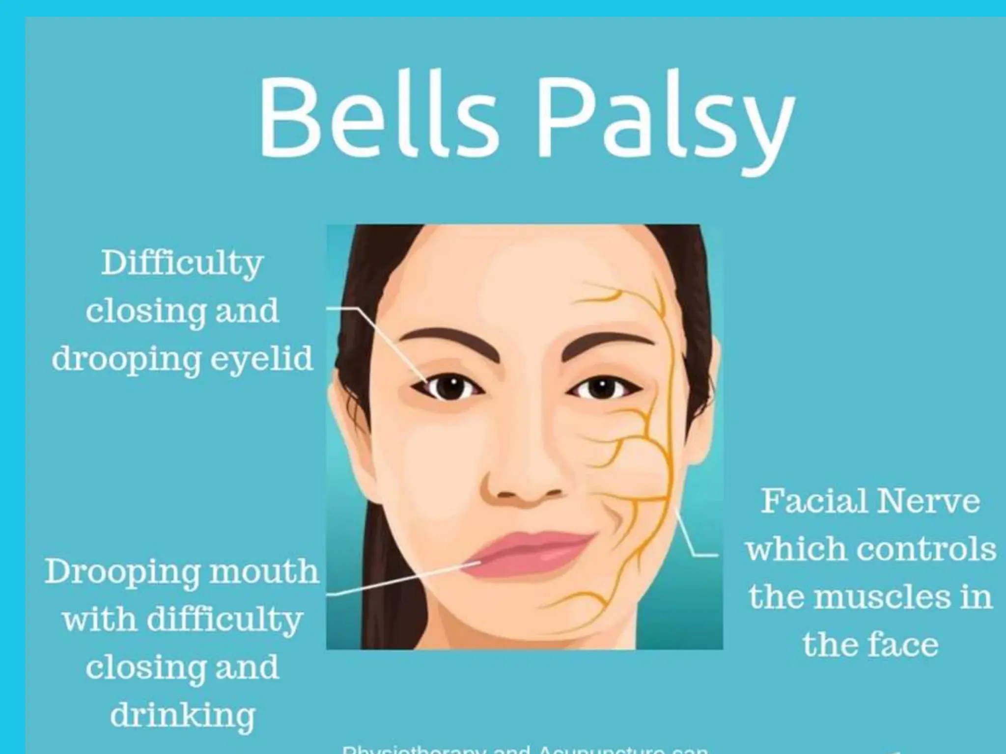 -Facial-Palsy-or-Bell-s-Palsy.pptx