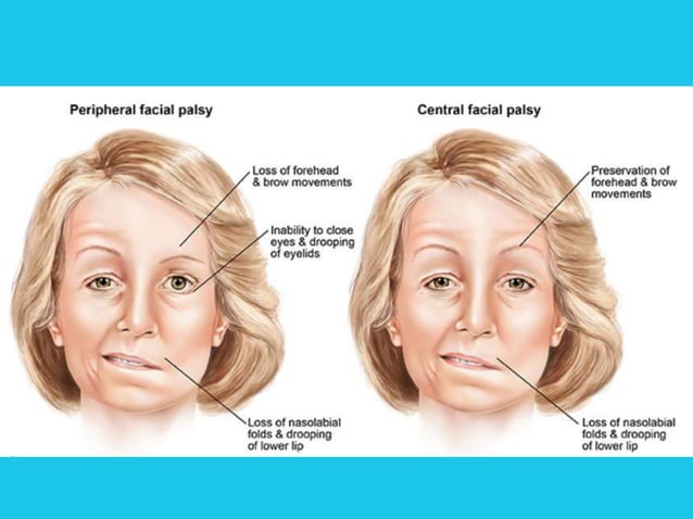 -Facial-Palsy-or-Bell-s-Palsy.pptx | Brain and Nervous System Disorders ...