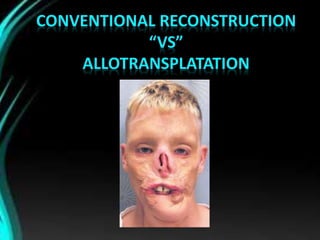 Facial allotransplantation | PPTX