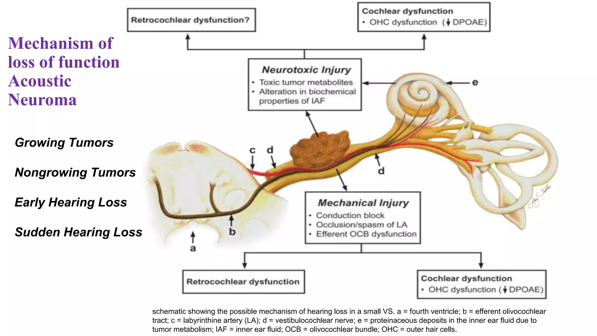Facial and Hearing Preservation in Acoustic Neuroma Surgery | PPT