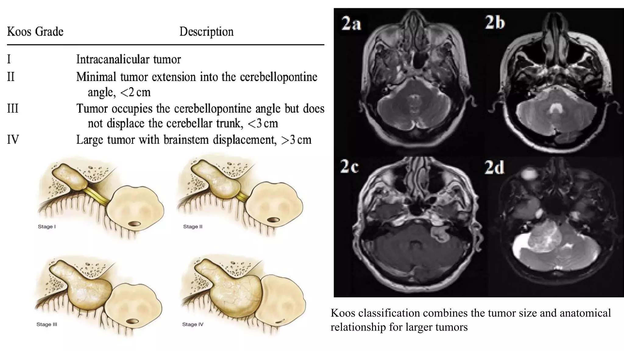 Facial and Hearing Preservation in Acoustic Neuroma Surgery | PPT