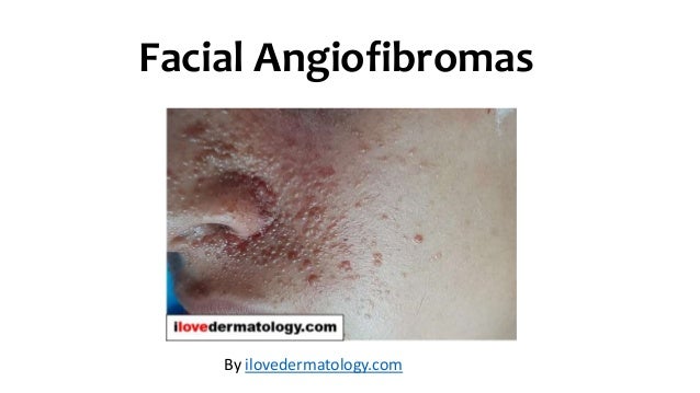 Facial Angiofibromas.pptx