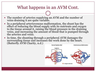 Facial arteriovenous malformations | PPTX