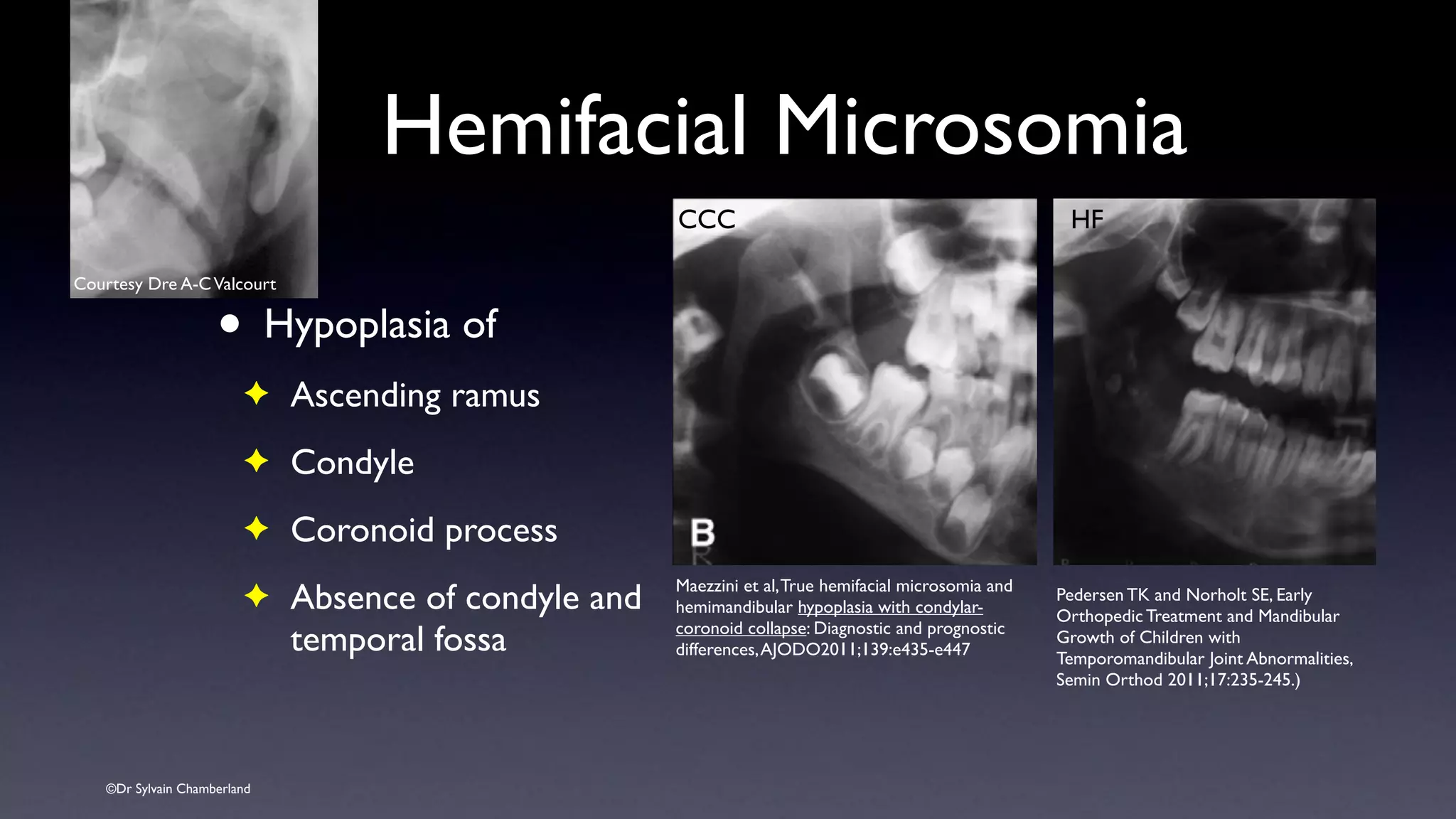Facial asymmetry condylar hyperplasia or condylar hypoplasia (v a dgkfo ...