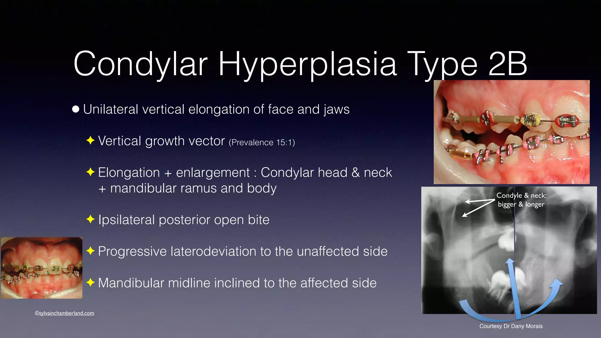 Facial asymmetry condylar hyperplasia or condylar hypoplasia (v a dgkfo ...